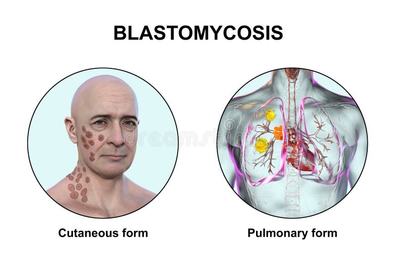Clinical Forms of Blastomycosis, 3D Illustration Stock Illustration ...