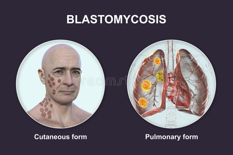 Clinical Forms of Blastomycosis, 3D Illustration Stock Illustration ...