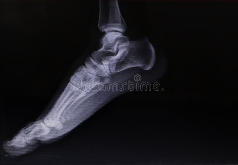 825 X Ray Ankle Foot Stock Photos - Free & Royalty-Free Stock Photos ...