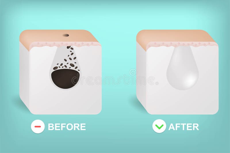 Clogged Pores and Clean Pores on Nose. before and after Skin Care ... Clogged Pores and Clean Pores on Nose. before and after Skin Care ...