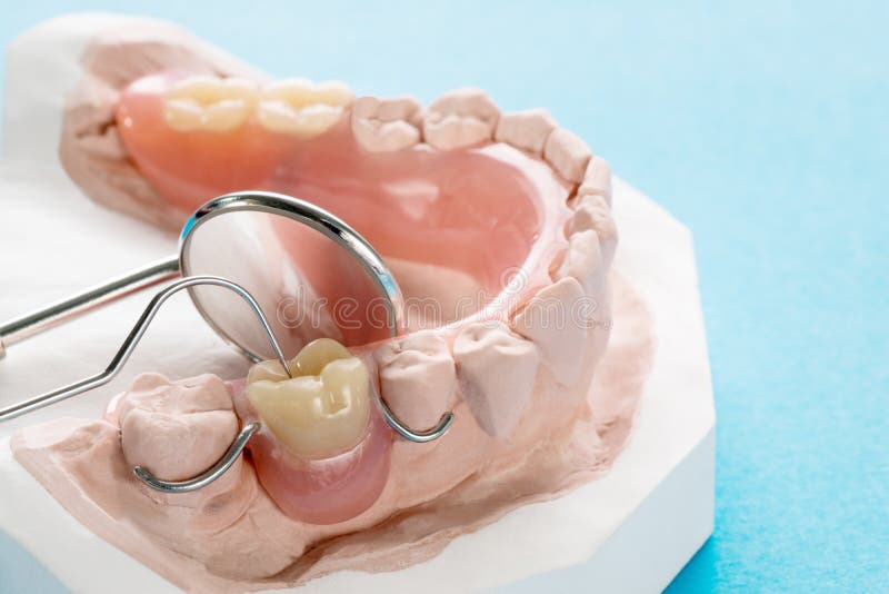 Artificial Removable Partial Denture. Stock Image - Image of equipment ...