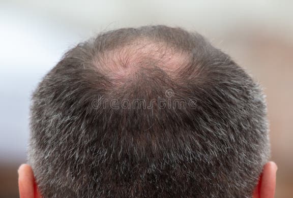 Close-up of a Bald Patch on a Man& X27;s Head Stock Photo - Image of ...
