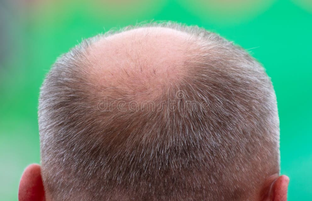 Close-up of a Bald Patch on a Man S Head Stock Photo - Image of human ...
