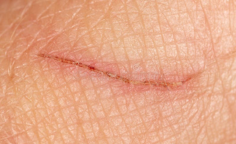 Close-up of Blood from a Wound on a Human Skin Stock Photo - Image of ...