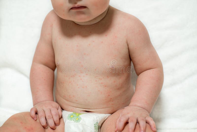 Close-up of Body of Child with Pimples of Chicken Pox. Pimples on the ...