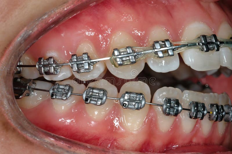Close-Up of Braces on Lower Teeth Stock Image - Image of patient ...