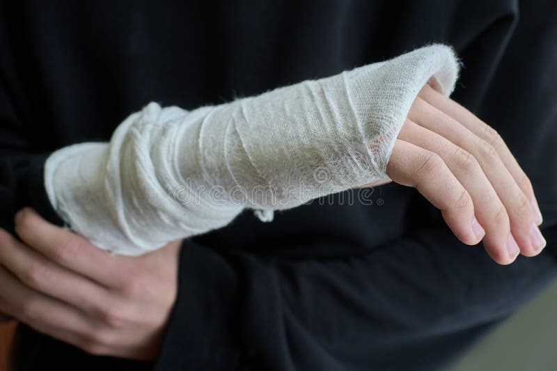Close-up of a Broken Arm of a Child in a Cast Stock Image - Image of ...