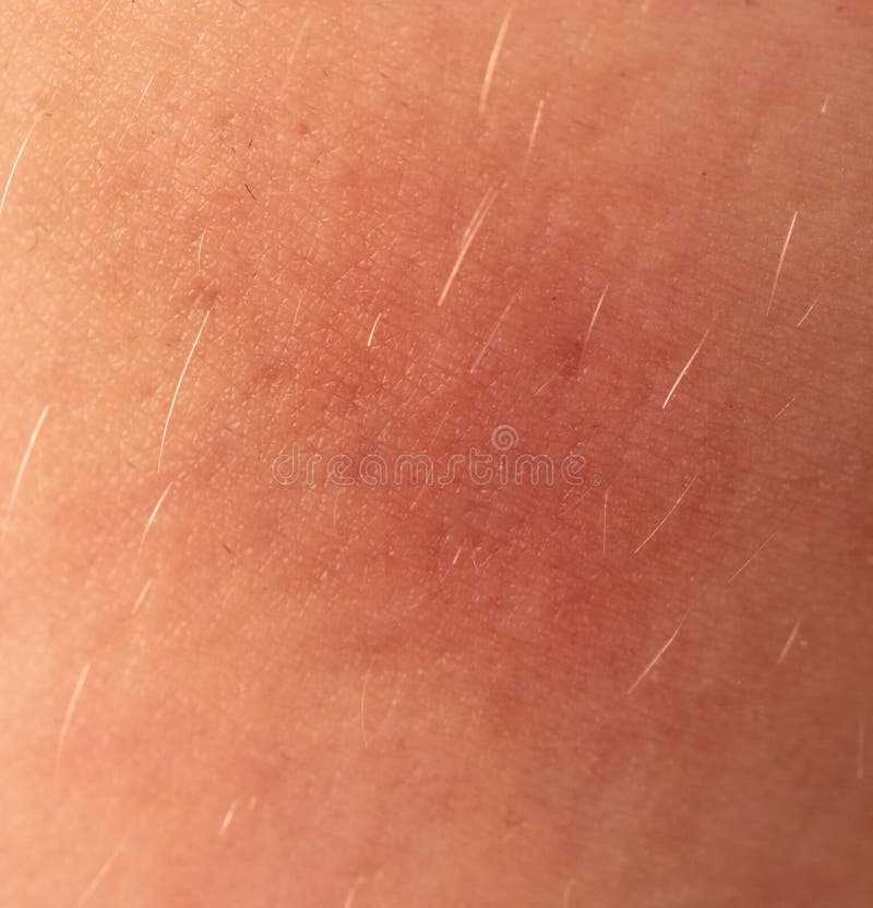 Close-up of a Bruise on the Skin. Macro Stock Image - Image of pain ...
