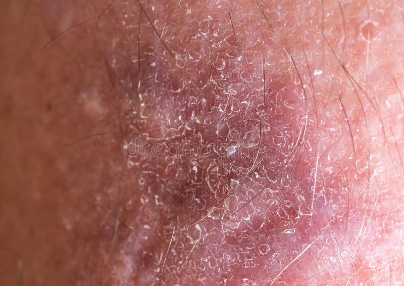 Close-up of Bumpy Skin with Blemishes and Scaly Epidermis, Dermatology ...