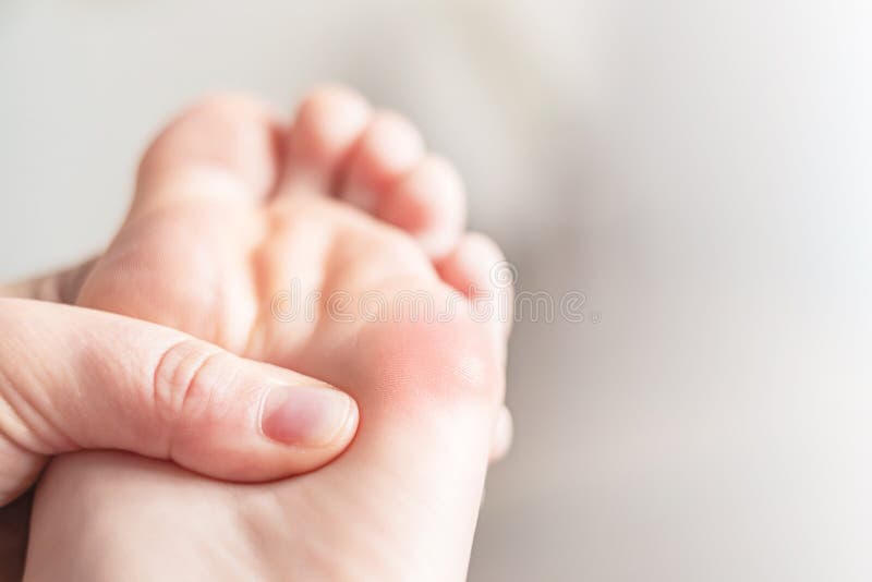 Close Up of Calluses. Problem Skin on the Steps of a Teenager Stock ...