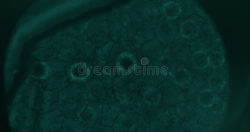 Cancer Cells Under Microscope at Laboratory Stock Footage - Video of ...