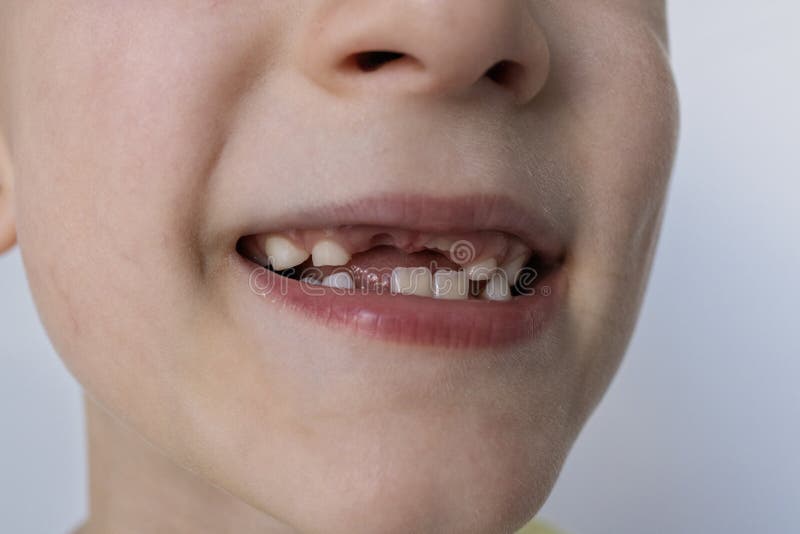 Close-up of a Child Mouth Showing Misaligned Teeth, Emphasizing Oral ...