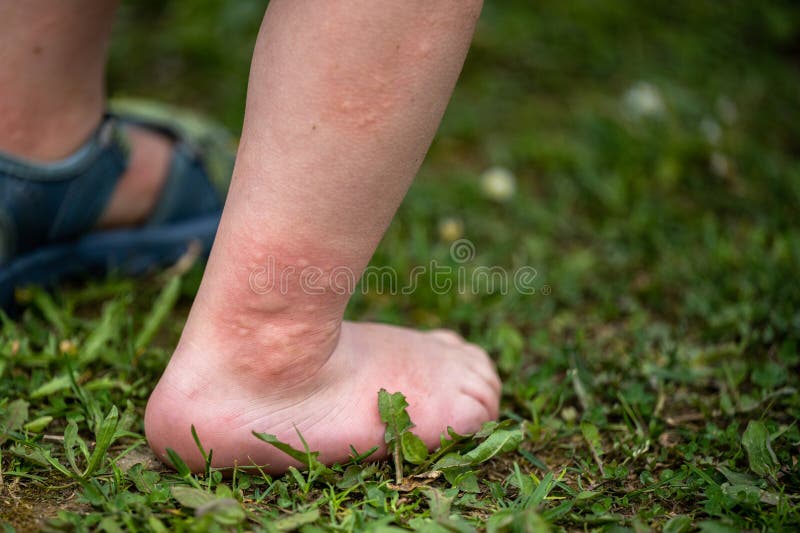 Close-up of a Child S Leg with Stinging Nettle Blisters Stock Photo ...