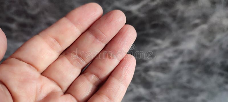 Close Up of Clavus or Corn on Finger. Dermatology Problem Stock Photo ...