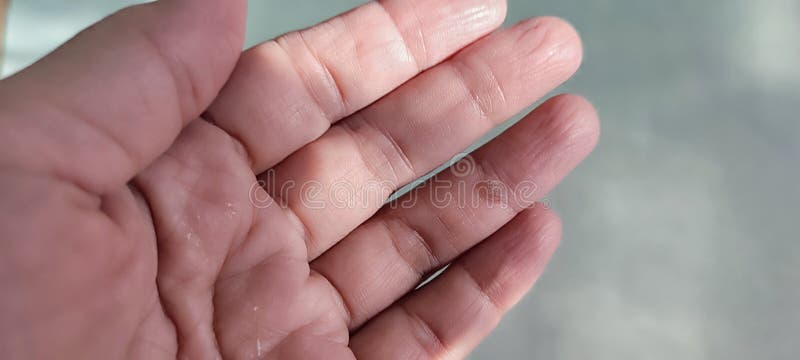Close Up of Clavus or Corn on Finger. Dermatology Problem Stock Photo ...