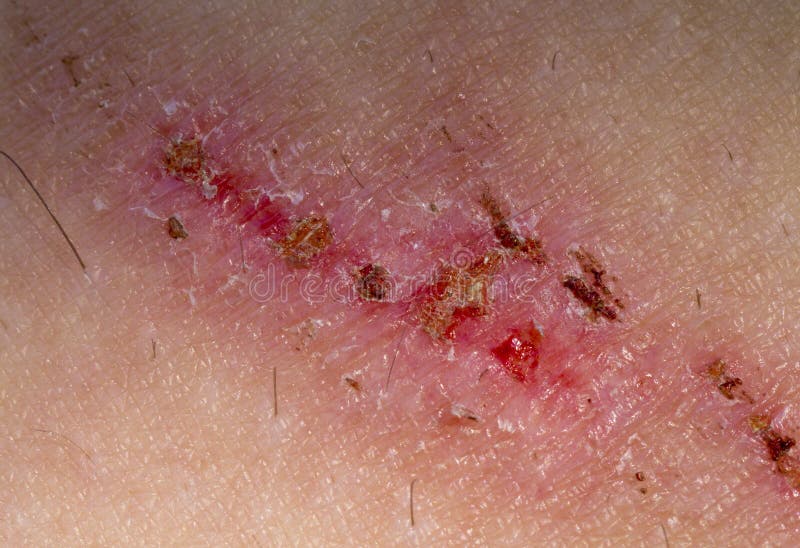 Close-up of a Deep Scratch on the Knee. Blood on the Skin Stock Photo ...