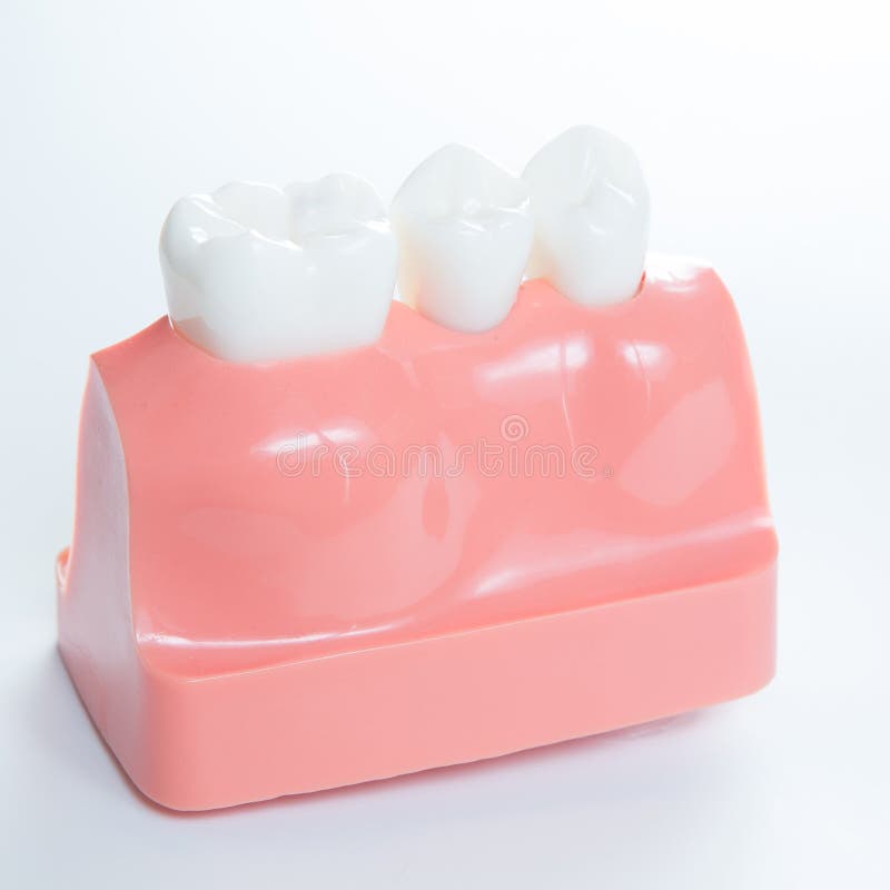 Close Up of a Dental Implant Model. Stock Photo - Image of model ...