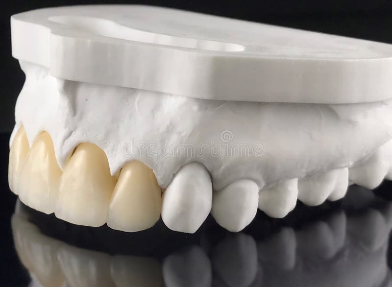 Close-up of Dental Prosthesis Porcelain Teeth in a Mold. Dental ...