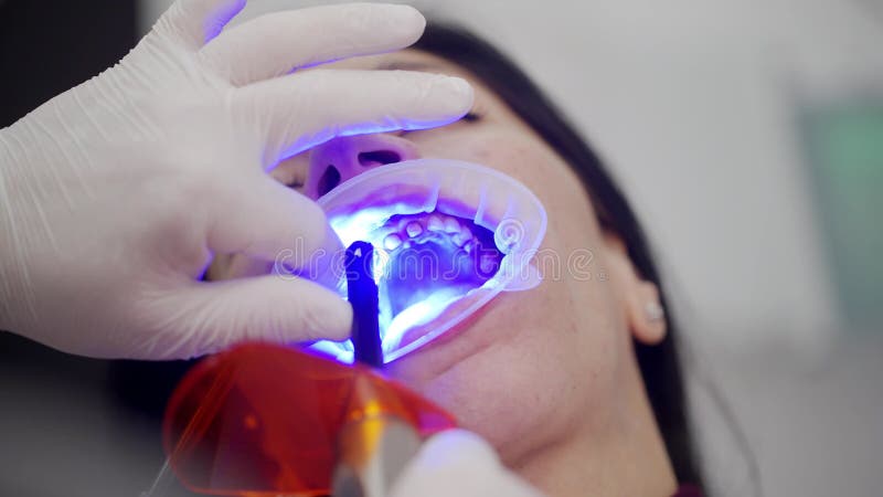 Close-up of Dentist S Hands Using UV Light for Bonding Zirconia Veneers ...