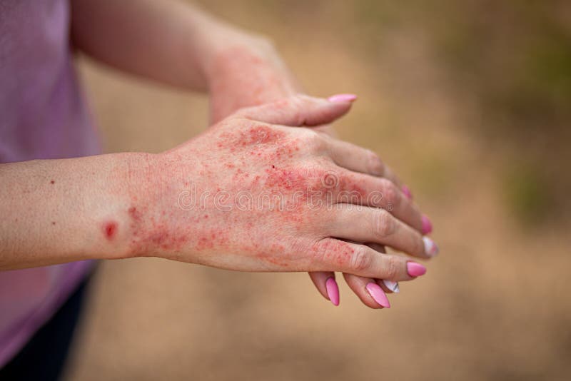 Close Up Dermatitis On Skin Ill Allergic Rash Eczema Skin Of Patient