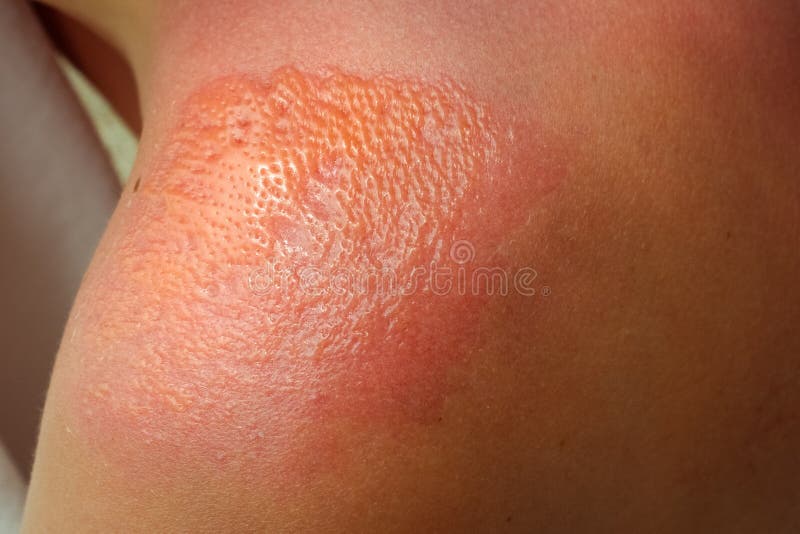 Close Up Detail Of A Very Bad Sunburn Stock Image Image Of Care Back 45545453