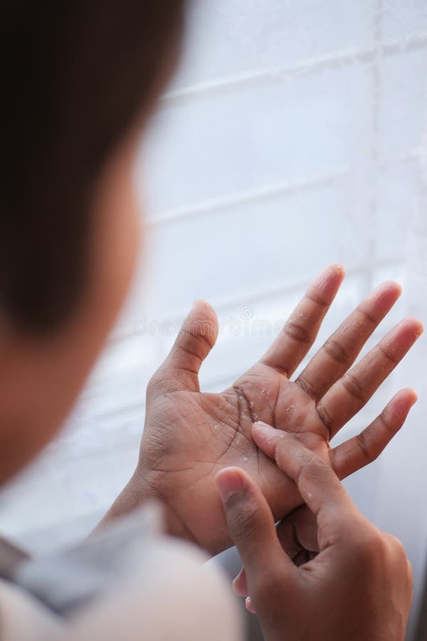 Close Up of Dry Cracked Skin of a Men S Hand Stock Image - Image of ...