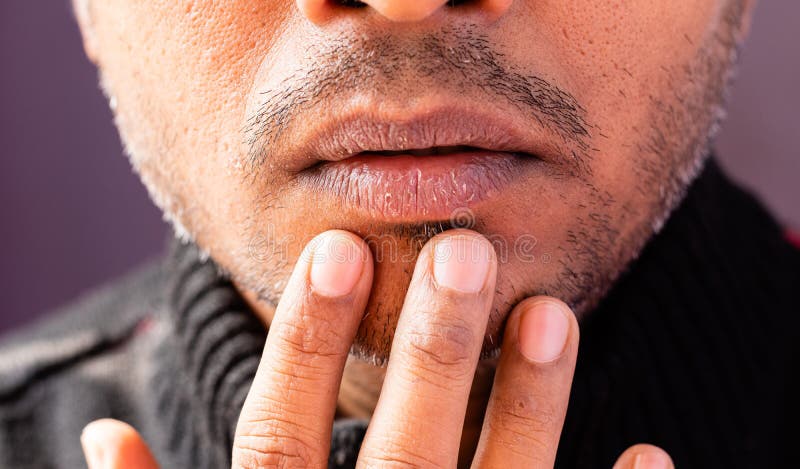 Dry lips problem stock image. Image of male, medicine - 264309649