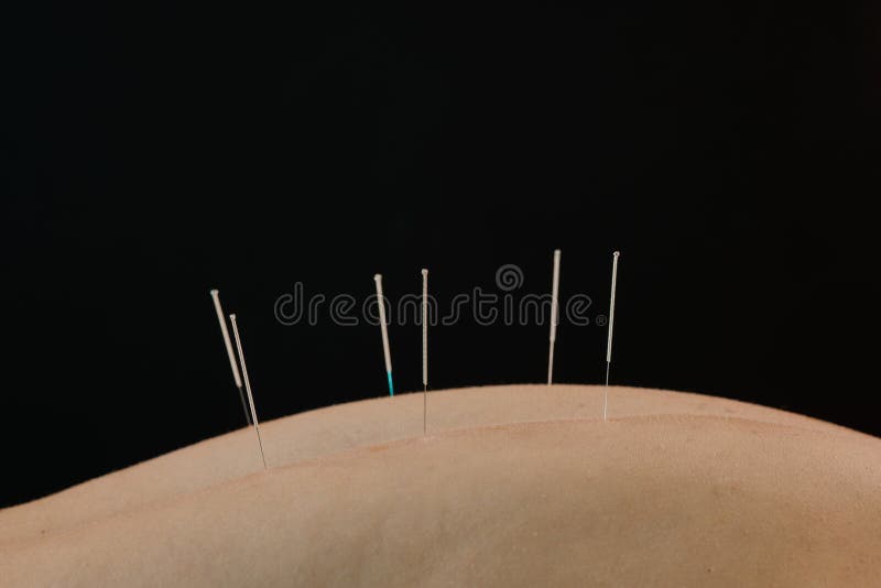 Close-up of a Dry Needling Session Where a Practitioner Inserts Thin ...