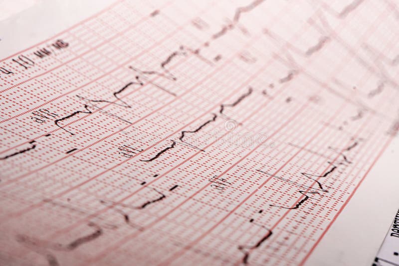 Close Up of ECG, Electrocardiogram. Work of a Healthy Heart on Paper ...