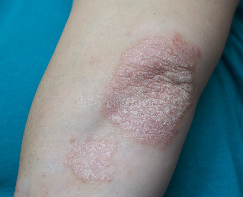 Elbow Skin Psoriasis Disease Problem Stock Photo - Image of dermatitis ...