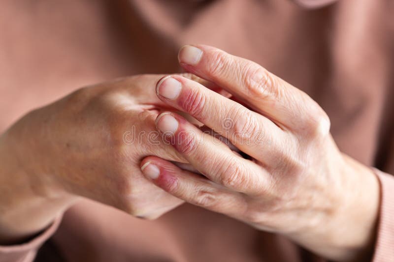 Woman Hands With Atopic Dermatitis Eczema Allergy Reaction On Skin