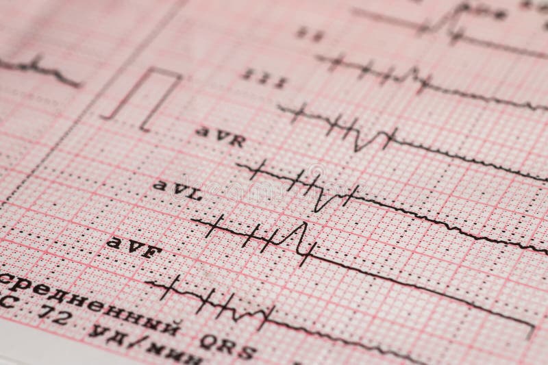 Close-up of an Electrocardiogram Printed on Blue Paper Stock Image ...