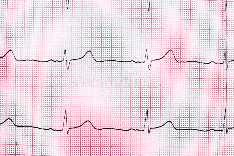 Close Up of an Electrocardiogram in Paper Form Stock Image - Image of ...