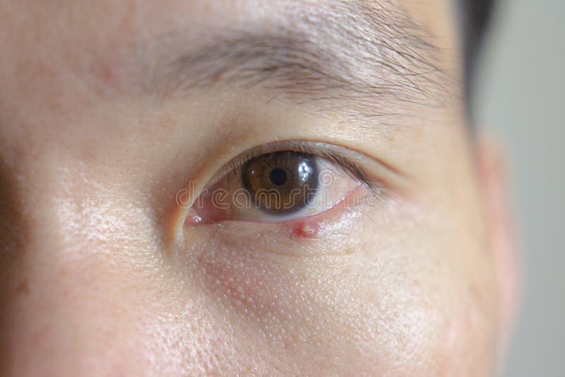 Close Up Eye Brown with Stye Infection. Stock Photo - Image of eyelid ...