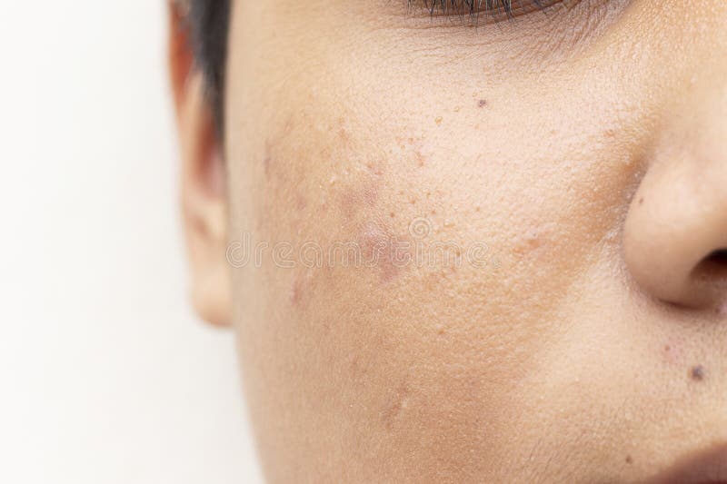 Close Up Face of Teenage Guy with Acne and Problem Skin Stock Image ...