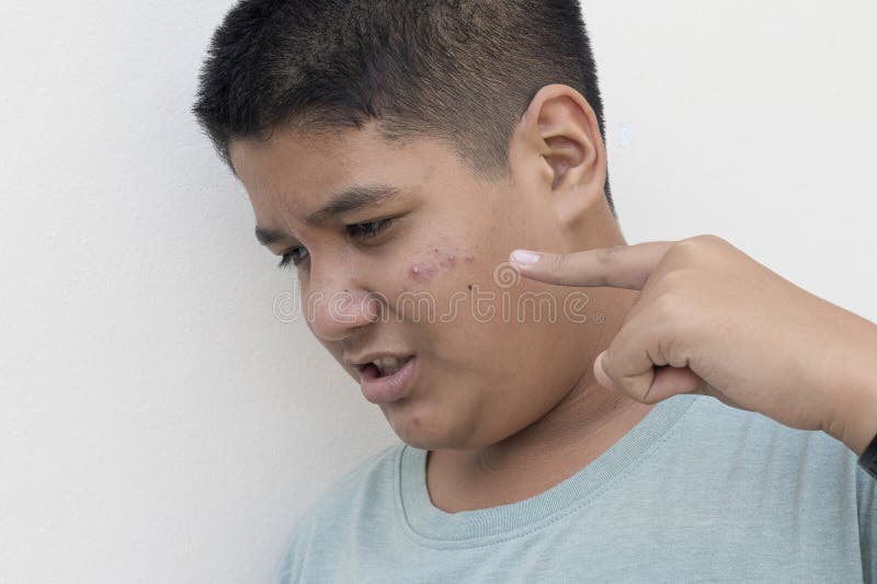 Close Up Face of Teenage Guy with Acne and Problem Skin Stock Photo ...