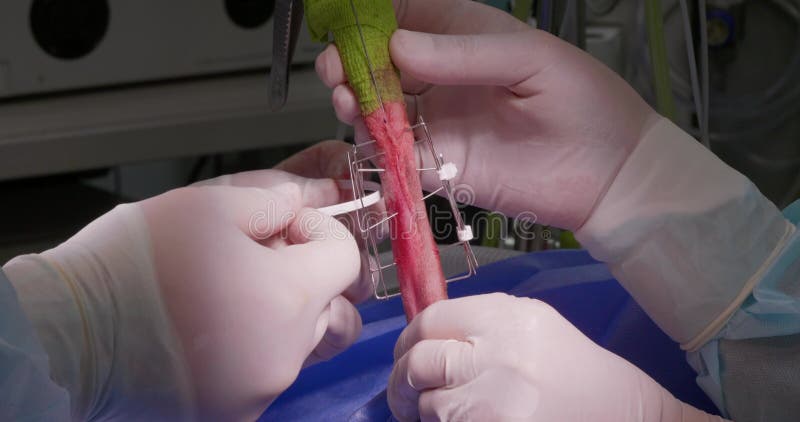 Close-up of Gloved Hands Performing Surgery on a Broken Bone. an ...