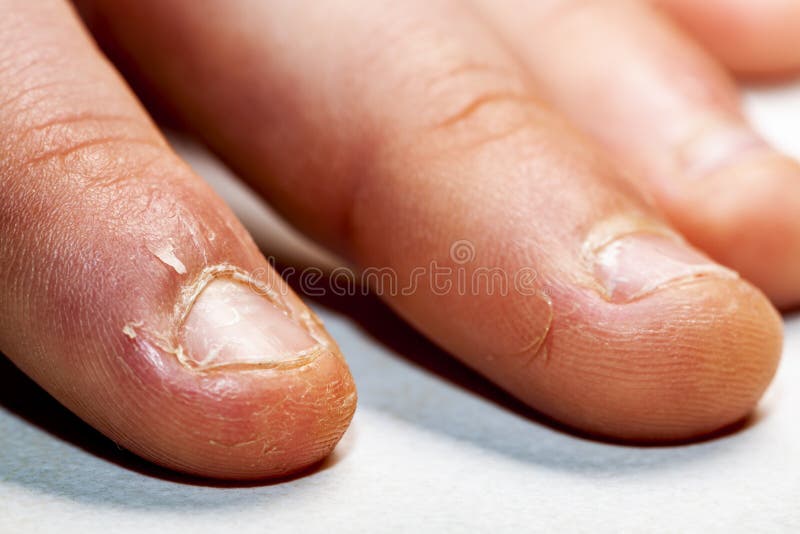 Close Up of Hand with Bitten Finger and Fingernails. Stock Image ...