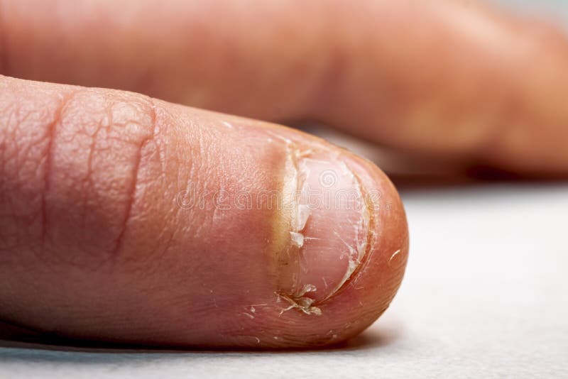 Close Up of Hand with Bitten Finger and Fingernails. Stock Photo ...