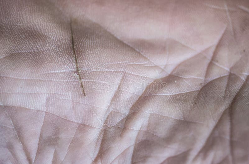 Close Up of Hand and Old Wound Stock Image - Image of adult, treatment ...