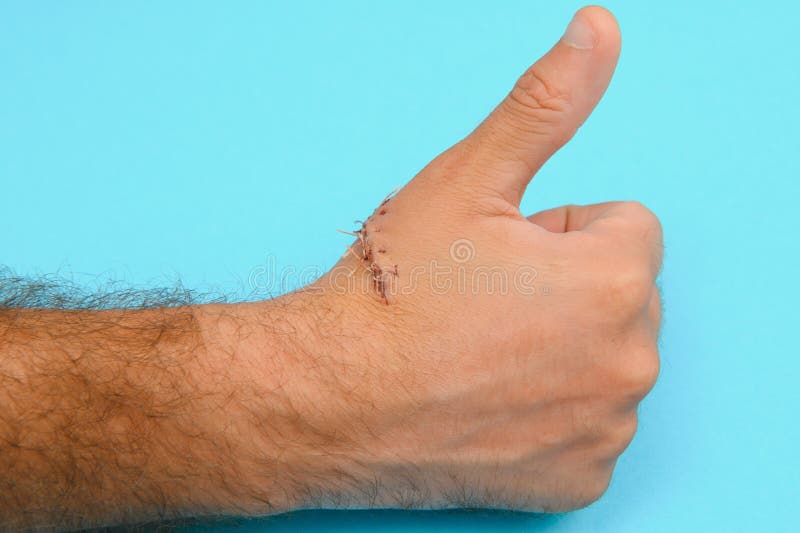 Close-up of a Hand Wound with Stitches Stock Photo - Image of incision ...
