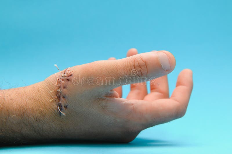 Close-up of a Hand Wound with Stitches Stock Photo - Image of heal ...