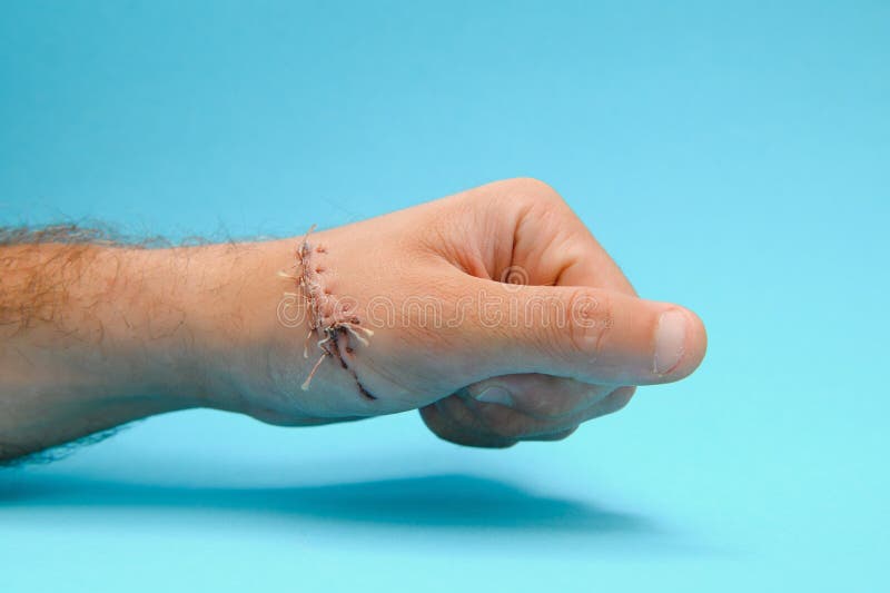 Close-up of a Hand Wound with Stitches Stock Image - Image of adult ...