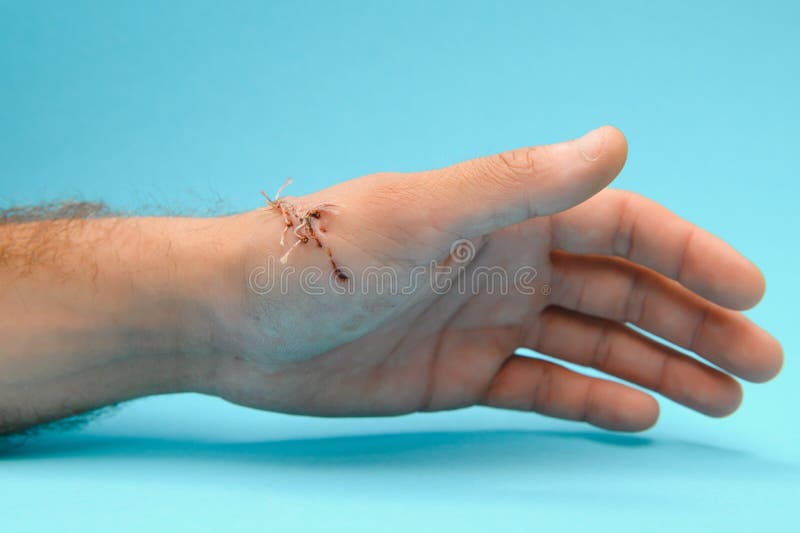 Close-up of a Hand Wound with Stitches Stock Photo - Image of body ...