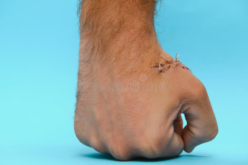 Close-up of a Hand Wound with Stitches Stock Photo - Image of medicine ...