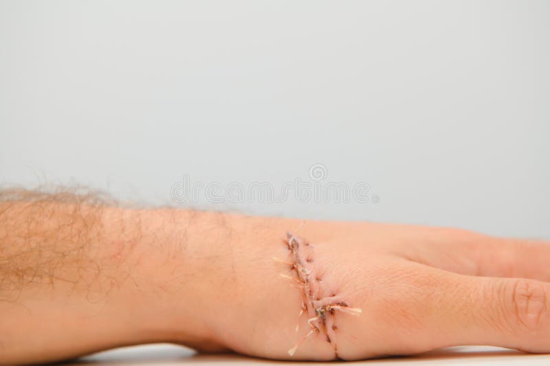 Close-up of a Hand Wound with Stitches Stock Photo - Image of incision ...