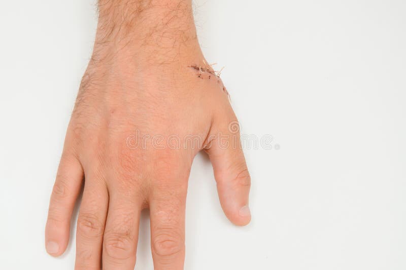 Close-up of a Hand Wound with Stitches Stock Image - Image of finger ...