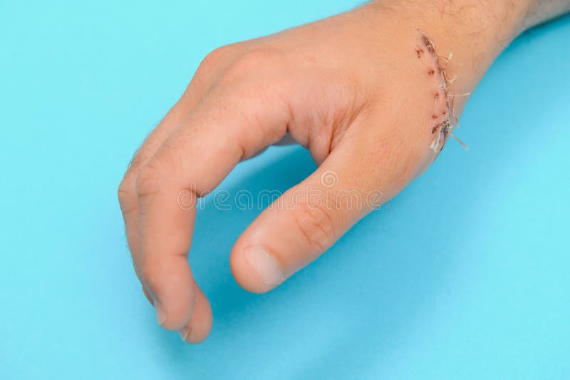 Close-up of a Hand Wound with Stitches Stock Image - Image of clinic ...