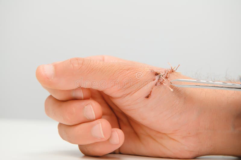 Close-up of a Hand Wound with Stitches Stock Photo - Image of medical ...