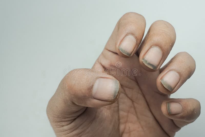 Close-up of Hands with Dirty Nails. Dirty Black Nails Stock Image ...